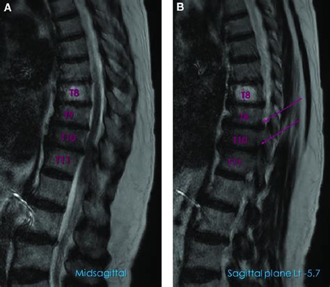 Sagittal Whole Spine Magnetic Resonance T2 Weighted Imaging Showing