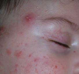 Acne Neonatorum Vs Erythema Toxicum
