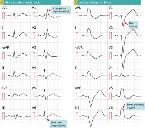 Right Bundle Branch Block RBBB ECG Criteria Definitions Causes