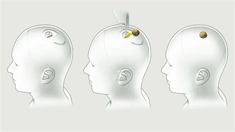 Elon Musks Neuralink Promises Relief From Chronic Illnesses Yet