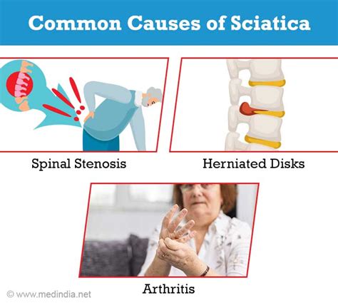 4 Types Of Sciatica Pain