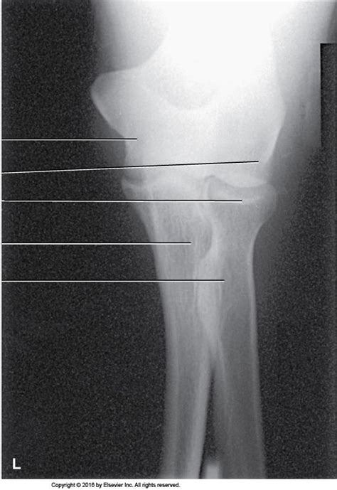 Ap Elbow Radiograph Partially Flexed Showing Proximal Forearm Diagram
