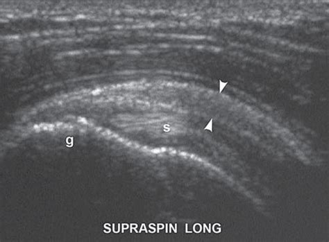 Ultrasound Diagnosis Of Subacromial Impingement For Lesions Of The