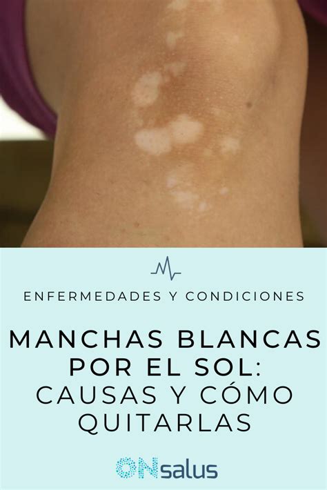Manchas BLANCAS en la piel por el SOL causas y cómo quitarlas