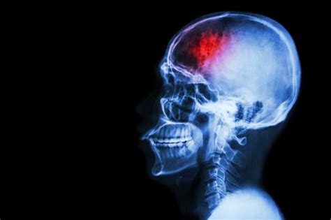 Udar mózgu rodzaje przyczyny leczenie MindHealth