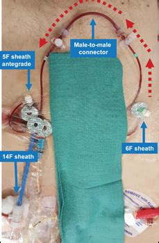 Femoral Sheath