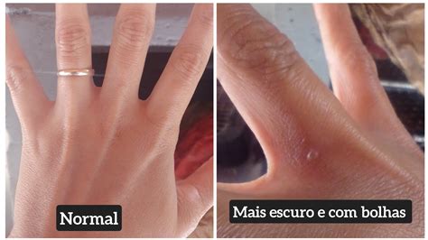 Mostrando na prática uma mancha queimadura de limão em mim YouTube