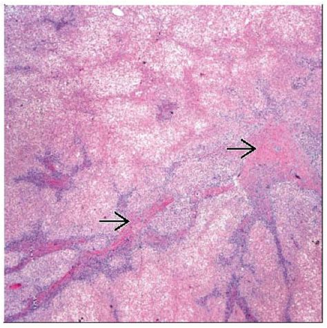 Focal Nodular Hyperplasia Histology