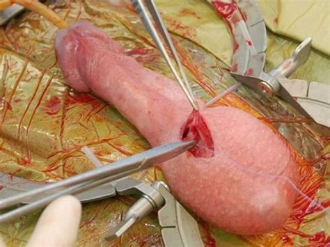 Penile Implant Surgery