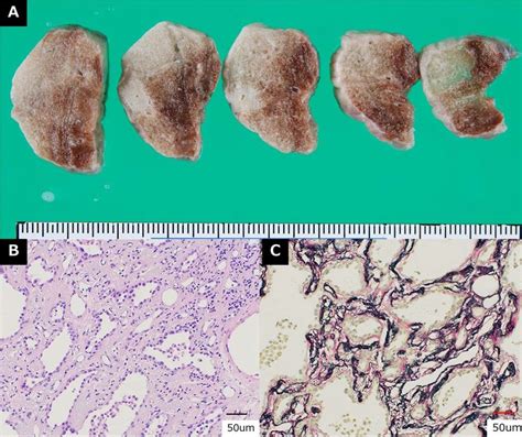 Pathological Findings A Macroscopic Specimen Of The Resected Tumors