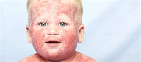 Atopijski Dermatitis Ekcem Halo Beba