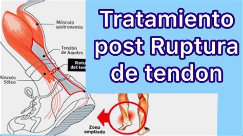 Como tratar una RUPTURA de tendón de aquiles en fase post operatoria