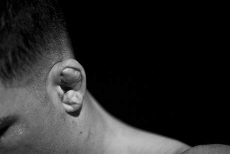 Causes And Treatments For Cauliflower Ear Health Detox Vitamins