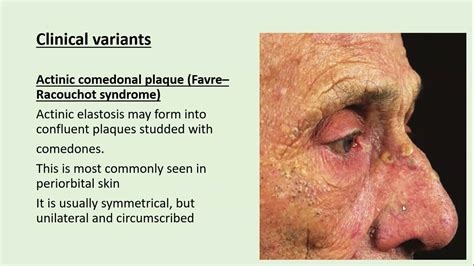 Lecture 147 Acquired Disorders Of Dermal Connective Tissues YouTube