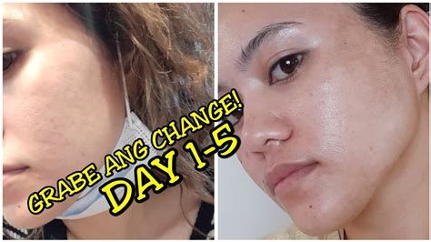 FRACTIONAL CO2 LASER BEFORE AFTER PROGRESS DAY 1 5 HOW TO REMOVE