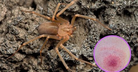 Araña violinista cómo reconocerla y qué hacer si te pica Salud180