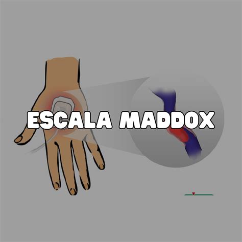 Escala de evaluación visual de flebitis de Maddox