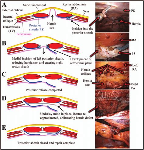 Diagram Lower Abdominal Incision Diagram Mydiagram Online