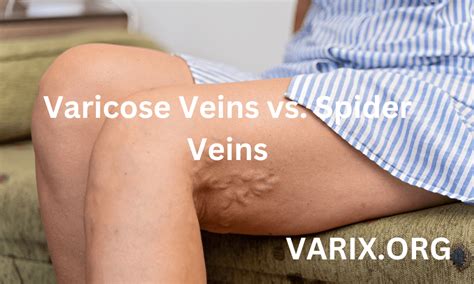 Varicose Veins And Spider Veins Spider Veins Plantecuador