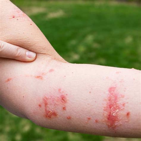 Poison Ivy Poison Oak Poison Sumac Fora Dermatology General