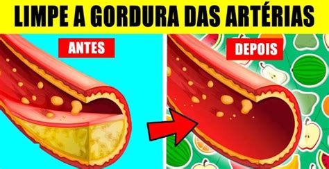 5 ALIMENTOS PARA LIMPAR AS ARTÉRIAS E PREVENIR UM ATAQUE CARDÍACO A A N