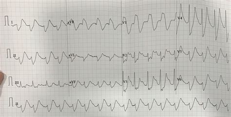d on twitter left bundle branch block n hyperkalemia n ventricular tachycardia