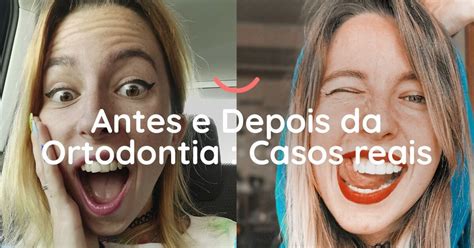 Antes E Depois Da Ortodontia Casos Reais