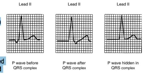 Junctional Arrhythmias And AV Blocks Flashcards Quizlet