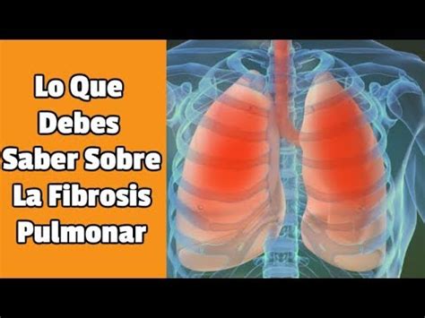 Lo Que Debes Saber Sobre La Fibrosis Pulmonar Fibrosis Pulmonar
