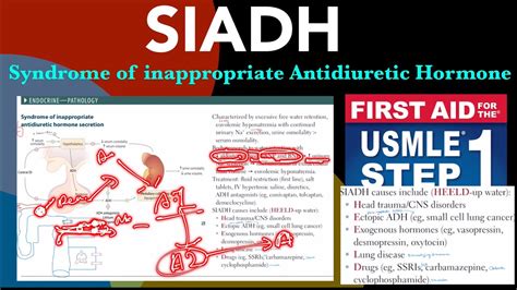 SIADH Syndrome Of Inappropriate ADH Syndrome In Hindi Urdu By First