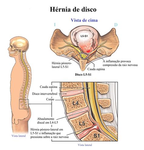 Hérnia de disco na coluna lombar expulsa central ou foraminal