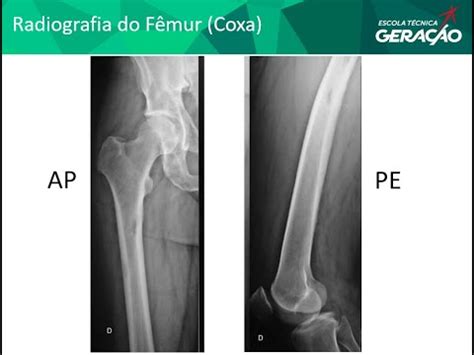 Radiografia do Fêmur AP Perfil YouTube