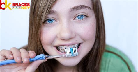 How Often Should You Brush Your Teeth With Braces