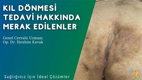 Kıl Dönmesi Tedavisi Hakkında Merak Edilenler Op Dr İbrahim KAVAK