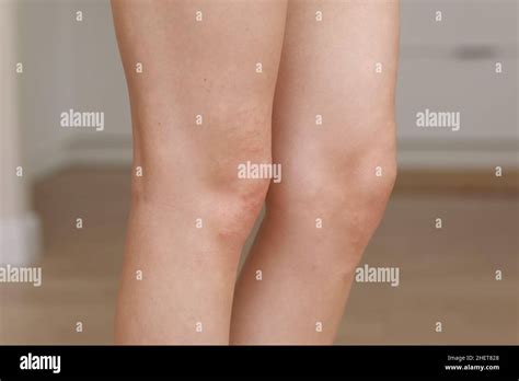 allergies cutanées jambes peau femmes Gros plan de pustules rouges sur