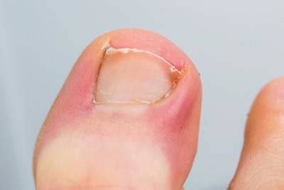 When To Seek Professional Help For An Ingrown Toenail