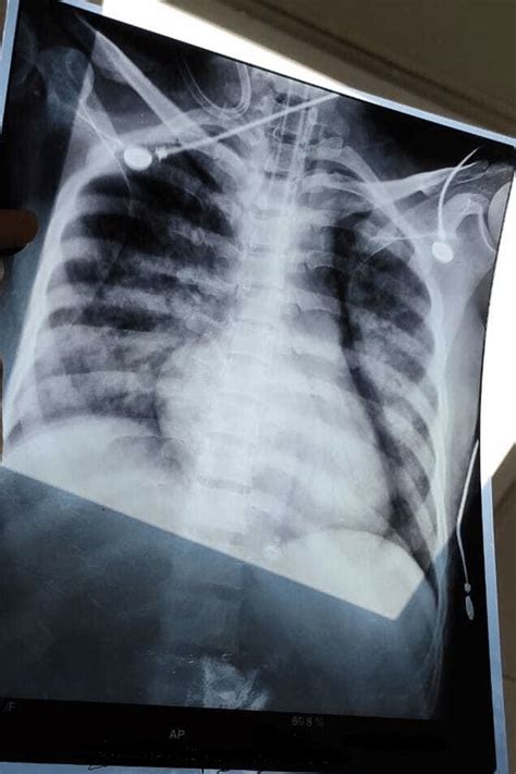 Antero Posterior Chest X Ray Showing Bilateral Diffuse Reticular