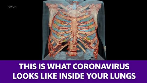 This 3 D Model Shows What Coronavirus Looks Like Inside Your Lungs