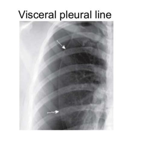 Pleural And Mediastinal Disease Flashcards Quizlet