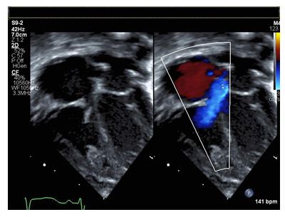 Neonate With Severe Tricuspid Regurgitation And Flail Anterior Leaflet