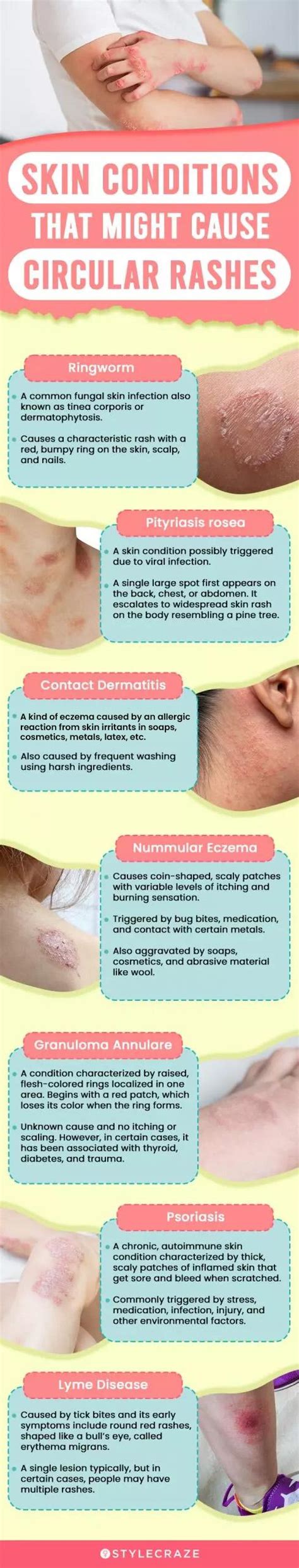The Red Circle On Your Skin Might Not Be Ringworm What Else Could It Be