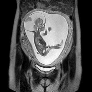 Baby Mri Scan Results Get More Anythink S