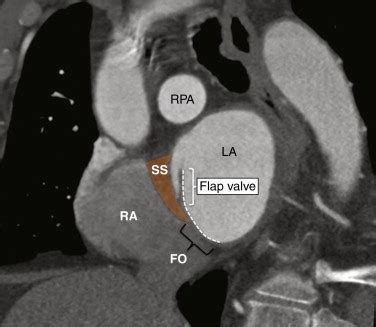 Septal Defects And Other Cardiovascular Shunts Radiology Key