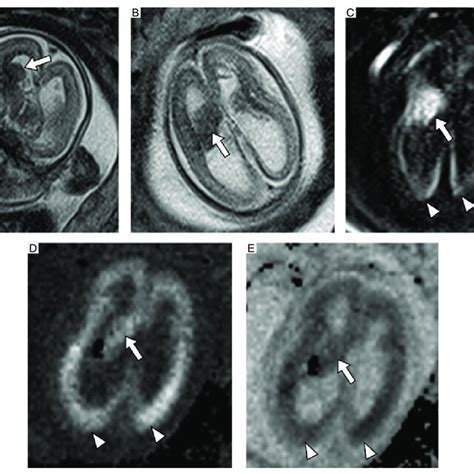fetal us and mri of the brain of a fetus at 32 weeks of gestation case download scientific