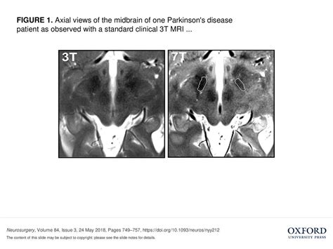 FIGURE 1 Axial Views Of The Midbrain Of One Parkinson S Disease