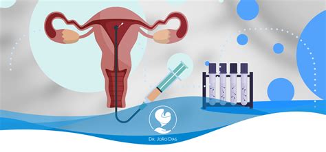 Insemina O Intrauterina Qual A Taxa De Sucesso Da T Cnica Dr Jo O Dias