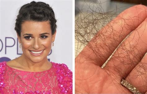 20 Female Celebrities With Hair Loss Wimpole Clinic