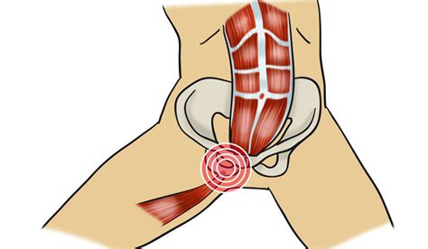 Pubalgia Causas síntomas y tratamiento de la osteopatía de pubis
