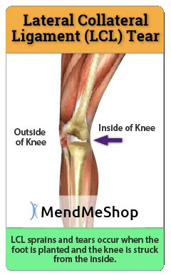 The Lateral Collateral Ligament LCL
