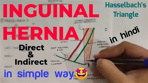 Inguinal Hernia Youtube